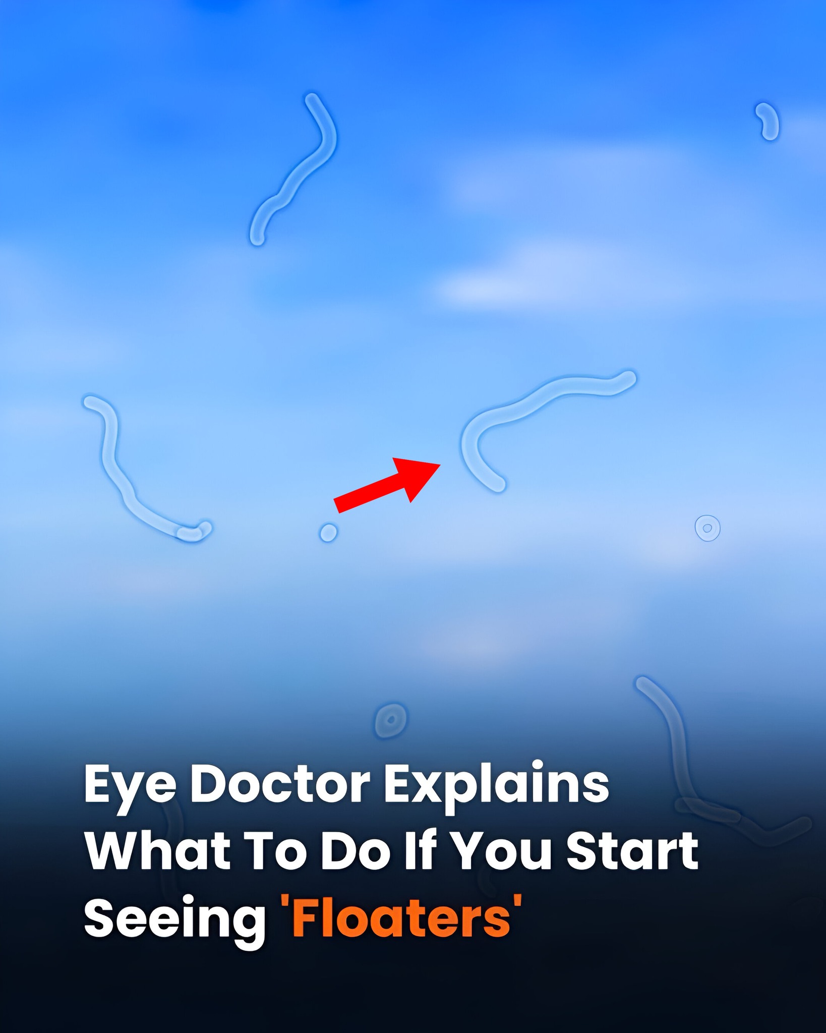 What Are Eye Floaters? Here What To Do If you Start Seeing Them